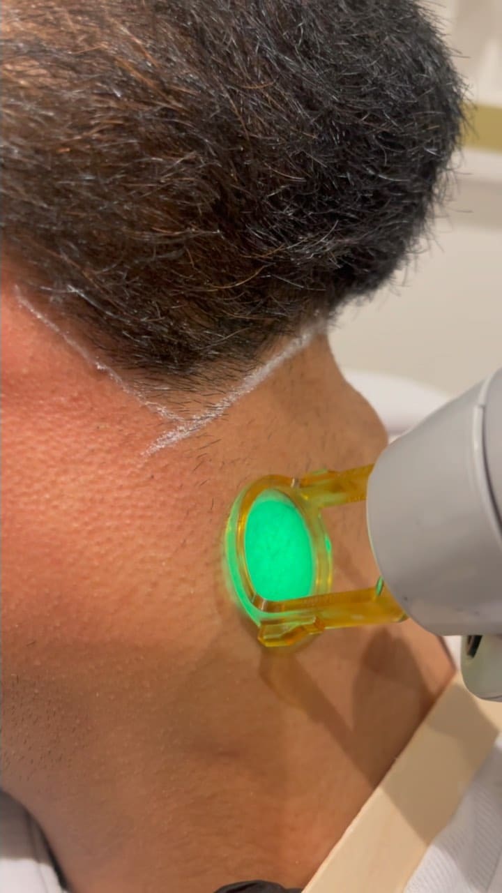 Laser Hair Removal for Men in Luton - Cost, Benefits - Skin House Luton