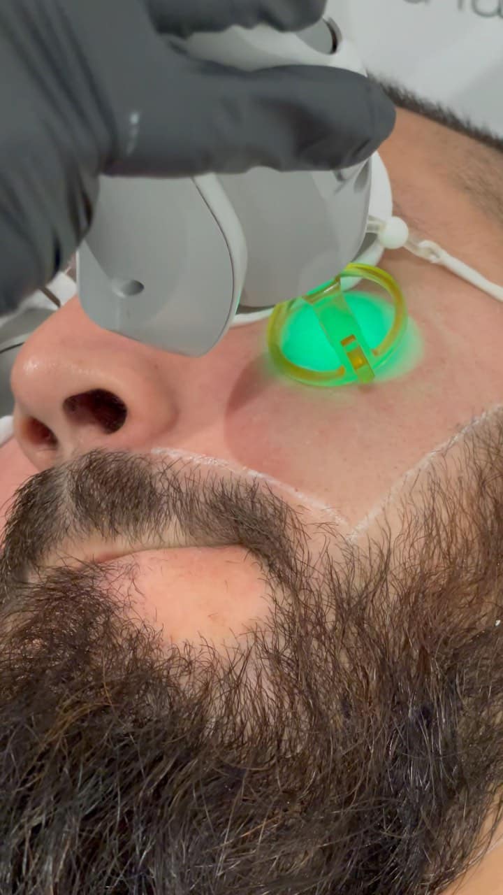 Laser Hair Removal for Men in Luton - Cost, Benefits - Skin House Luton