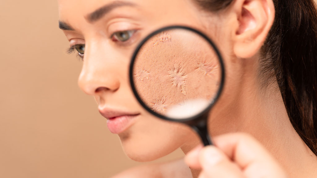 Acne Scarring - Acne Scar Treatments & Scar Removal - Skin House Luton