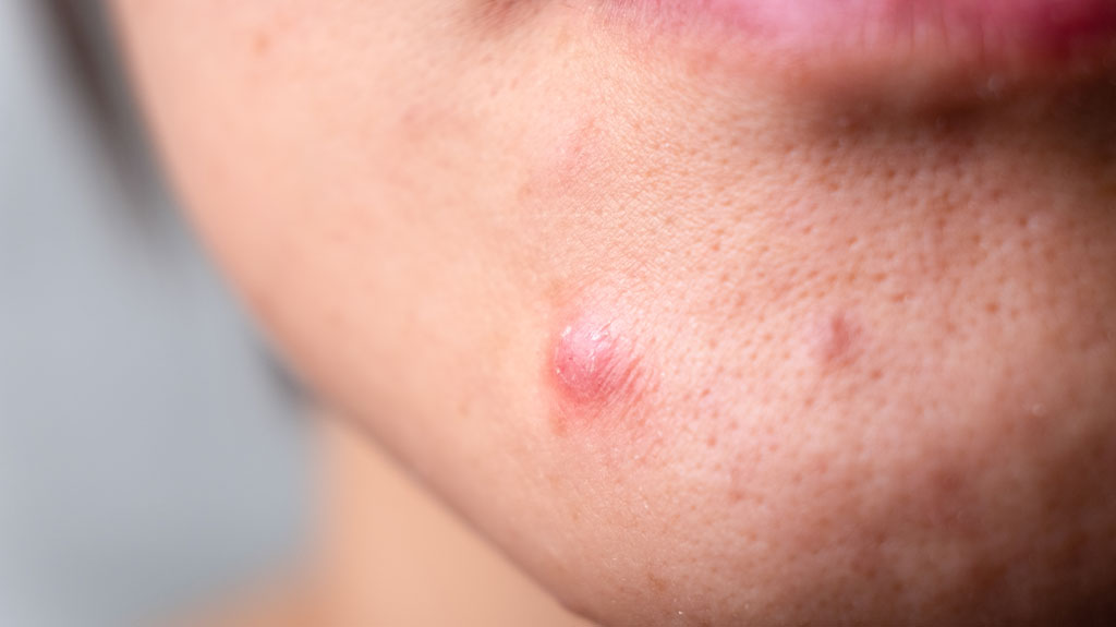 Acne Treatment - Skin House Luton