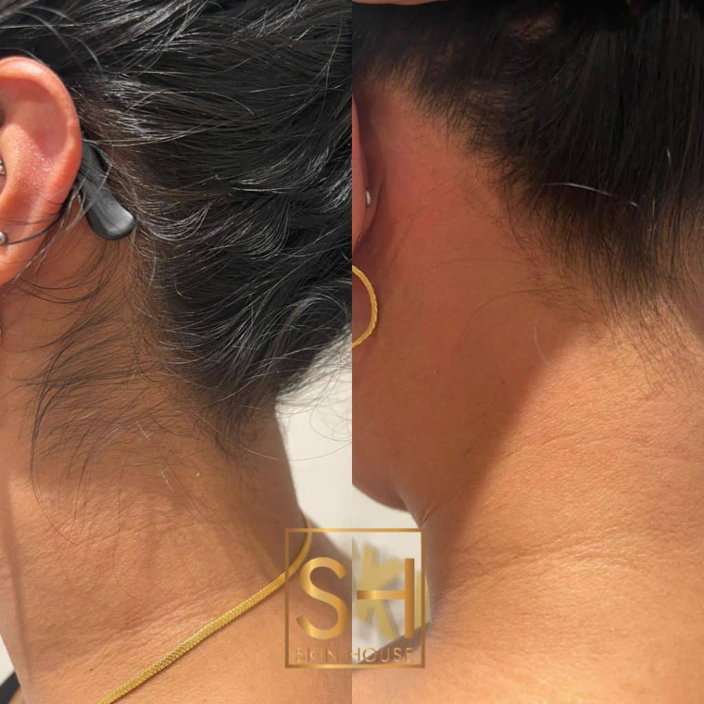 Skin House Luton | Aesthetics & Laser Clinic | Hair Removal Treatments