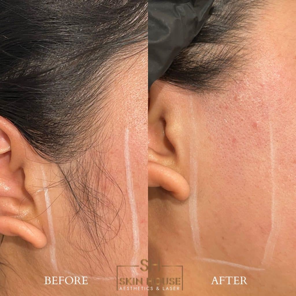 Skin House Luton | Aesthetics & Laser Clinic | Hair Removal Treatments