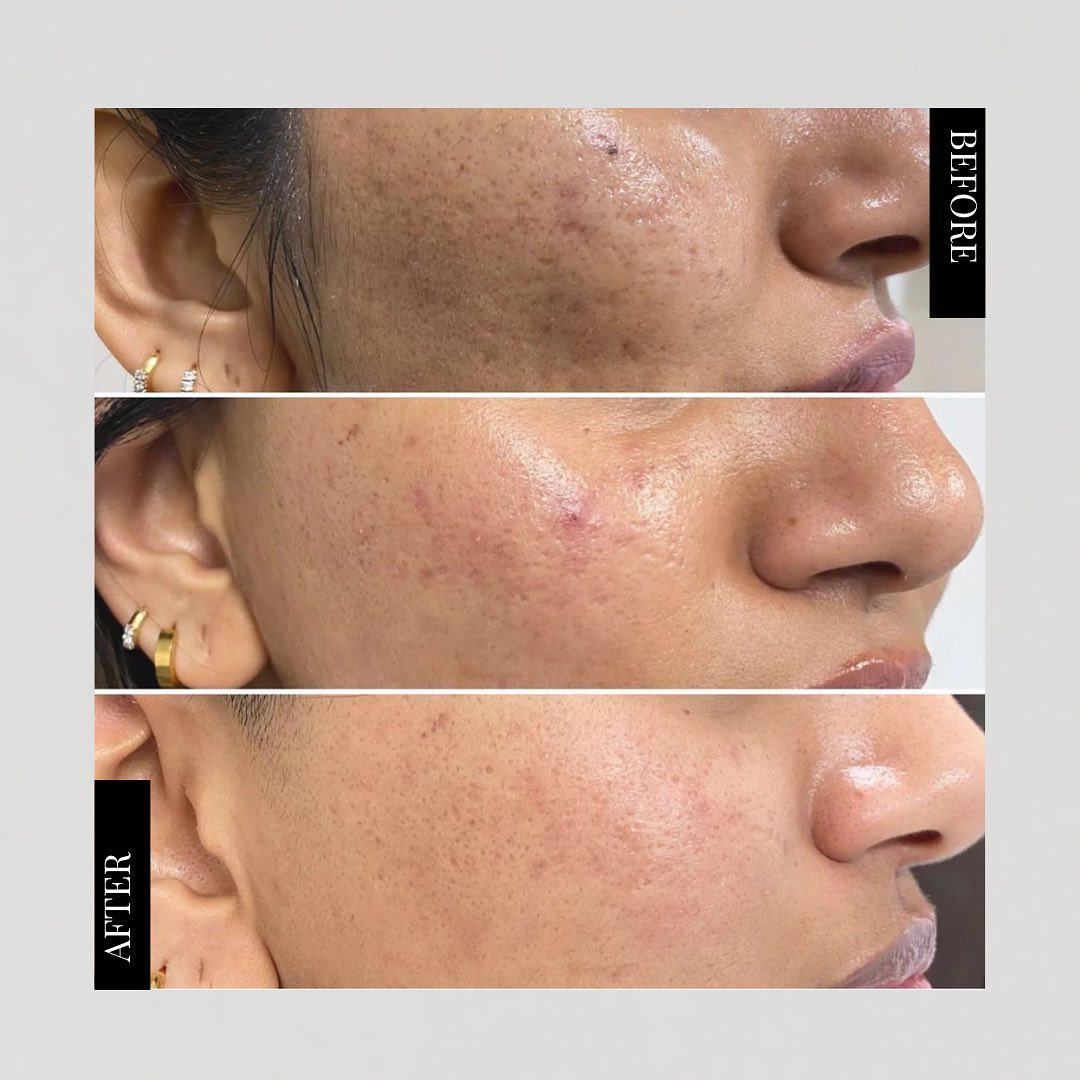 Laser Hair Removal, Male & Female - Skin House Luton