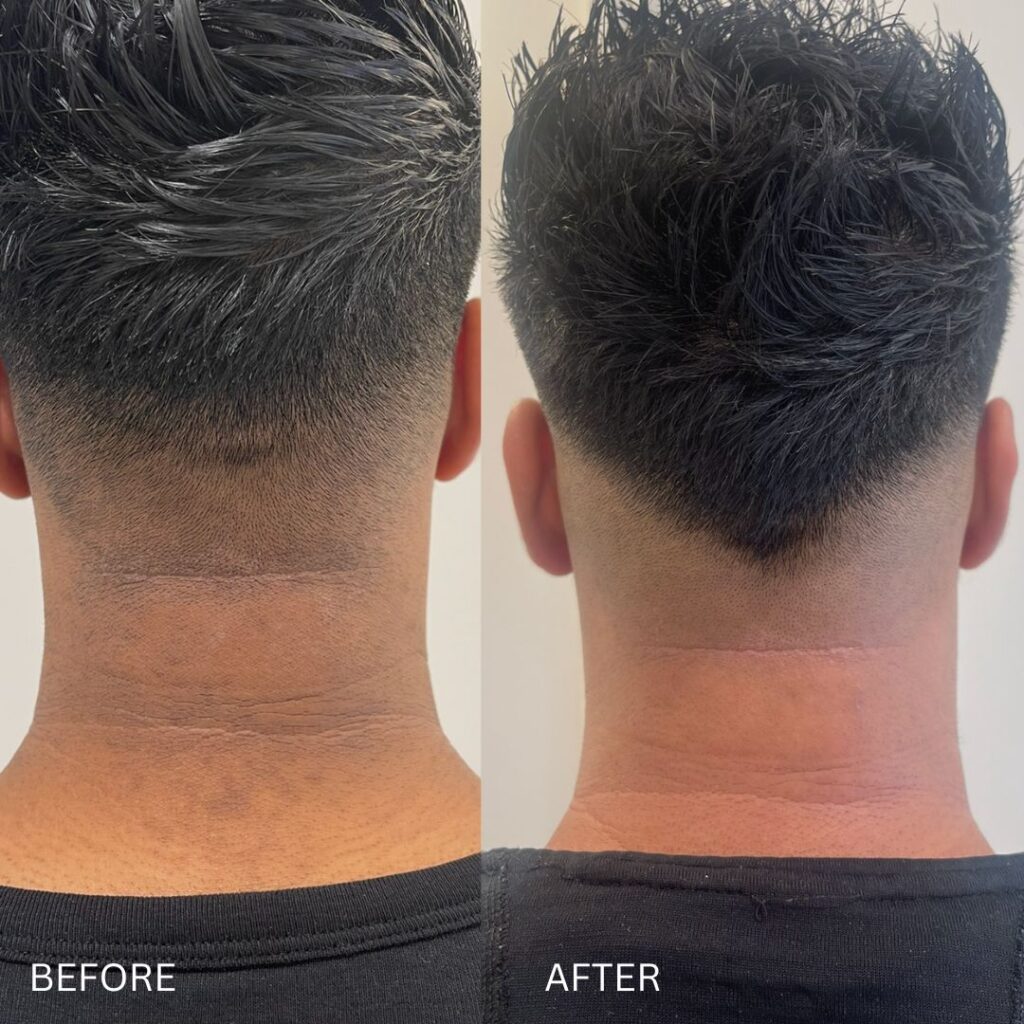 Skin House Luton | Aesthetics & Laser Clinic | Hair Removal Treatments