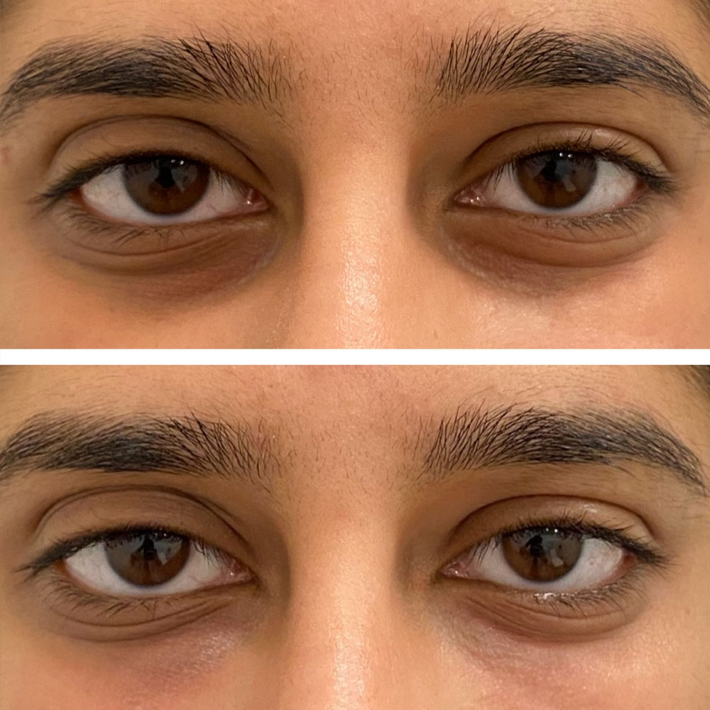 Polynucleotides Injectables at Skin House Luton - Elevate Your Features