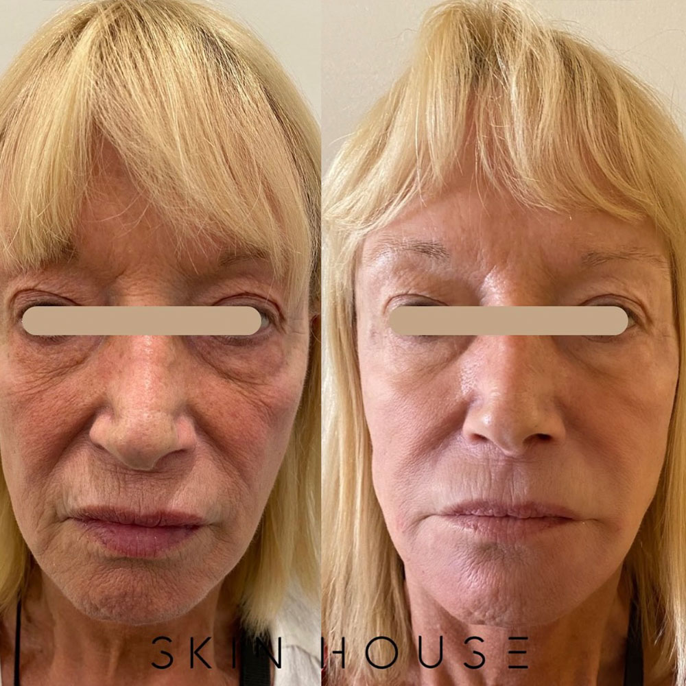 Polynucleotides Injectables at Skin House Luton - Elevate Your Features