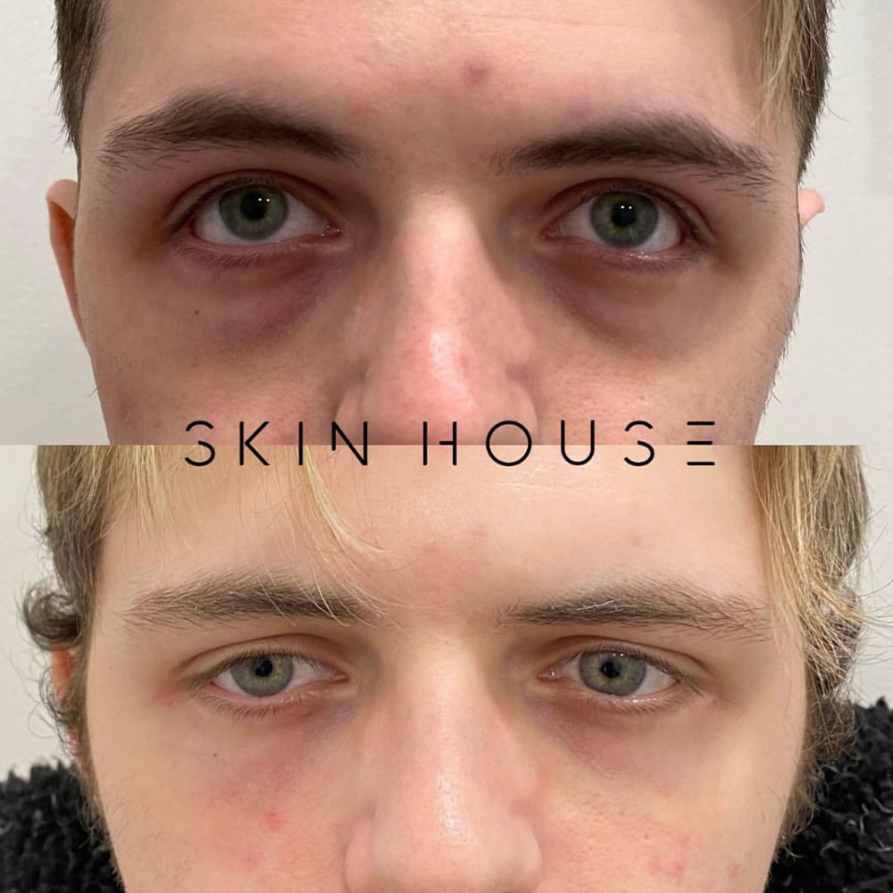 Polynucleotides Injectables at Skin House Luton - Elevate Your Features