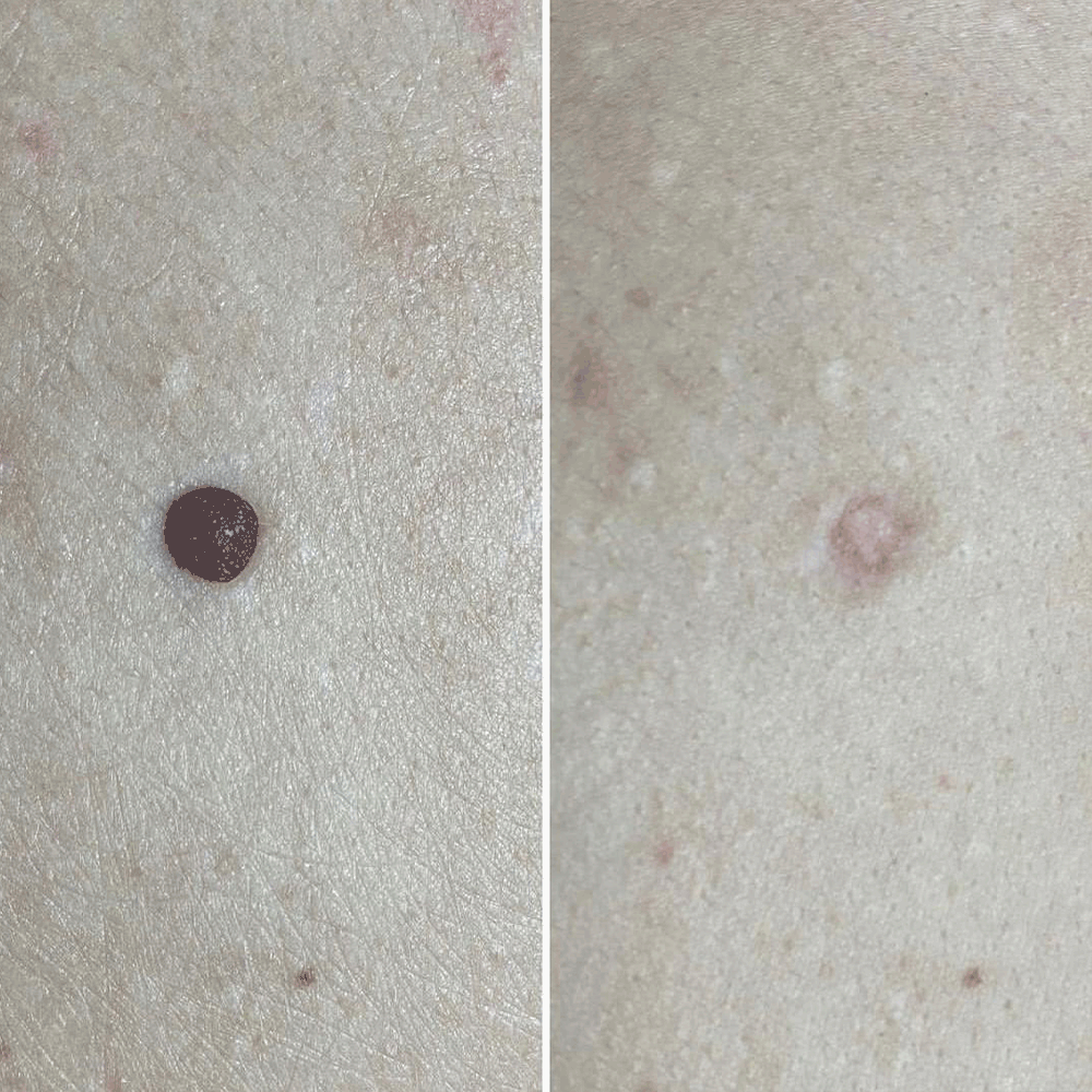 Cryopen – Skin House