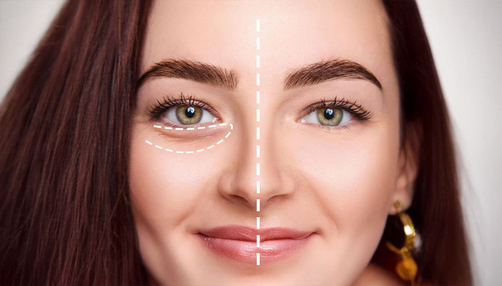Tear Trough Treatment at Skin House Luton - Elevate Your Features