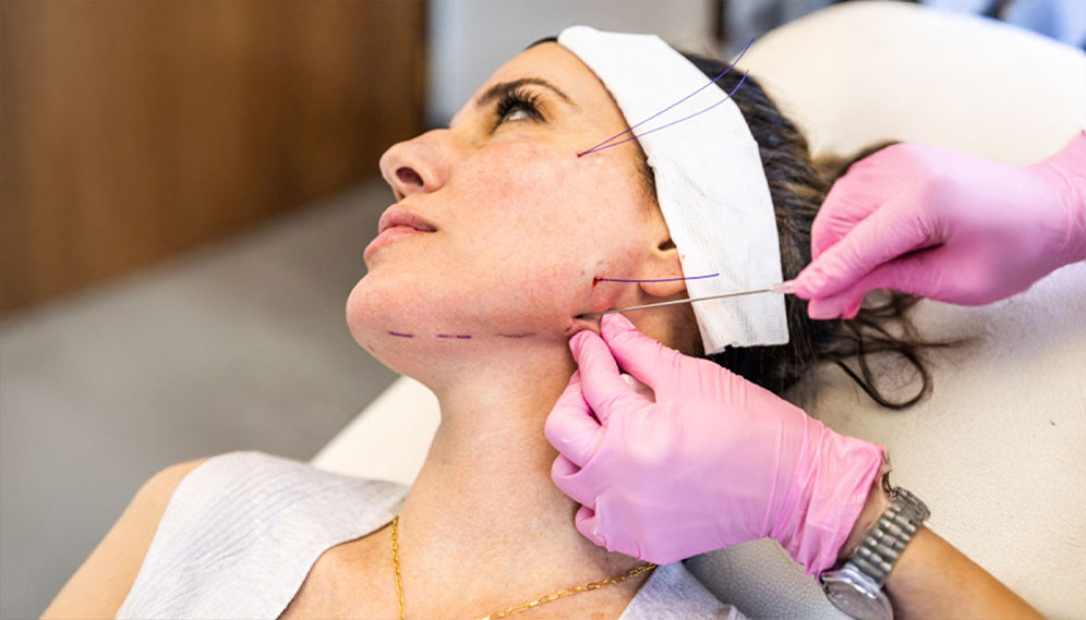Thread Lift at Skin House Luton - Elevate Your Features
