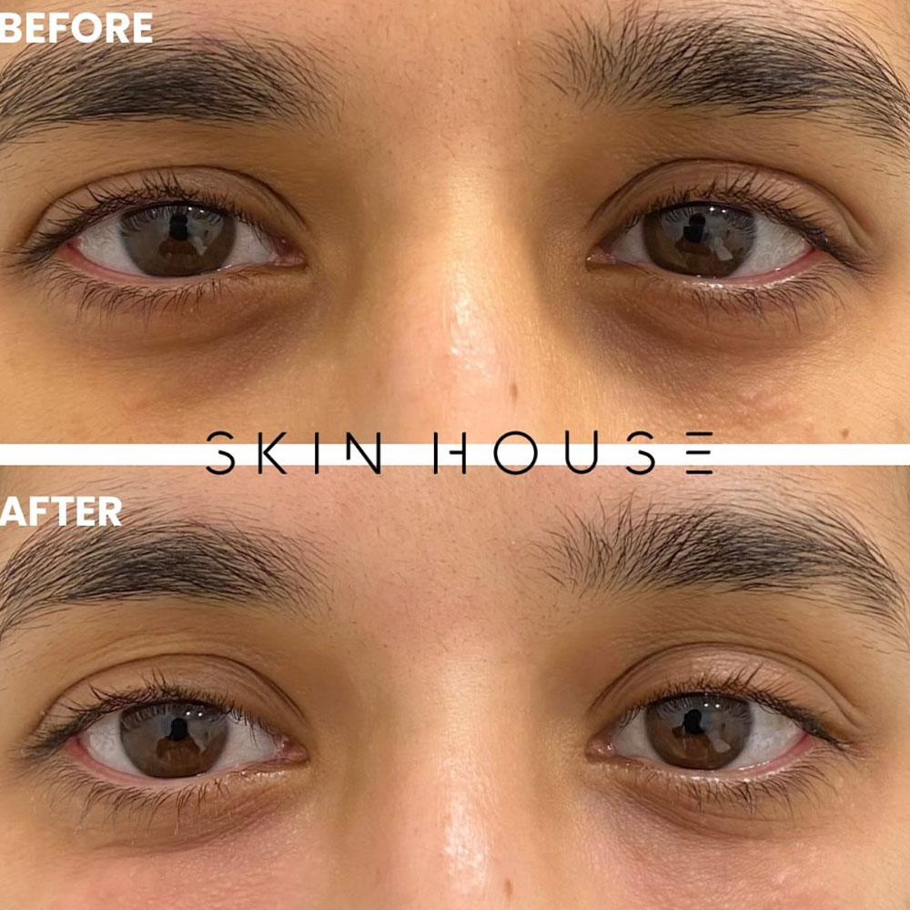 Dark Circles at Skin House Luton - Elevate Your Features