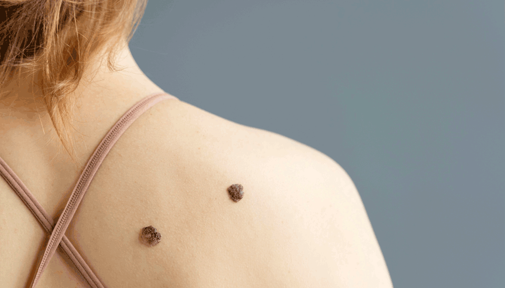 Skin Tag at Skin House Luton - Elevate Your Features