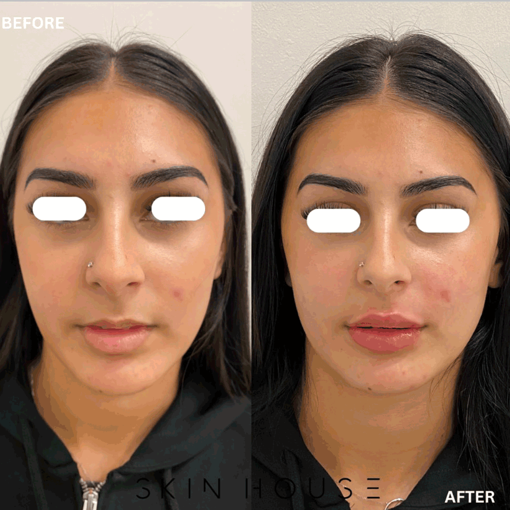 Perk Lip - Hydrafacial in Luton - Enjoy the offer for Fat treatment