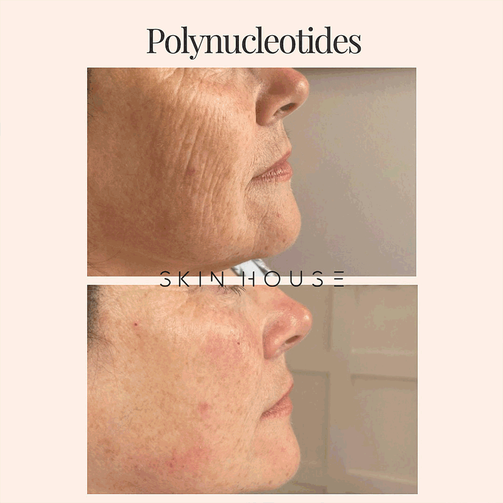 Polynucleotides Injectables at Skin House Luton - Elevate Your Features