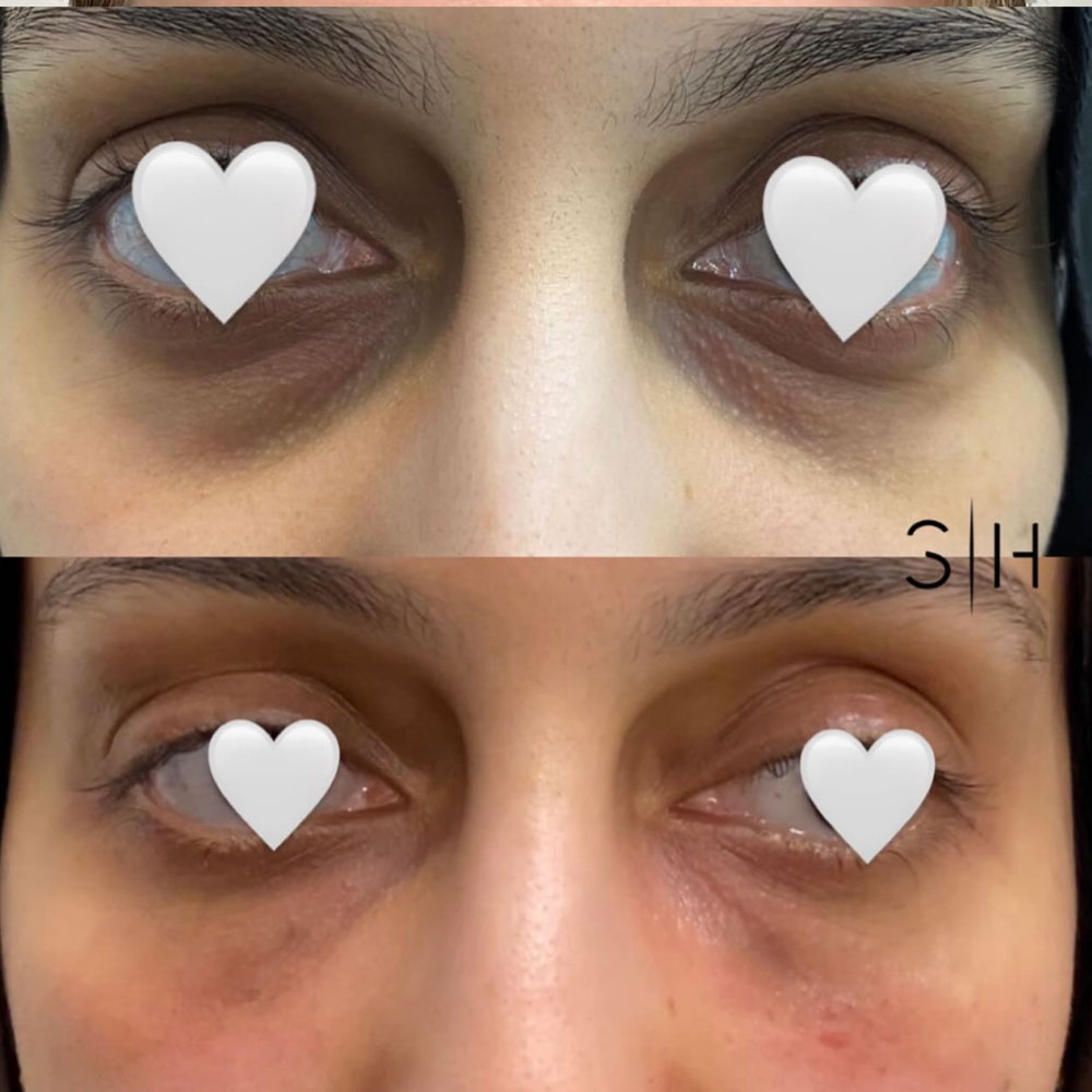 Dark Circles at Skin House Luton - Elevate Your Features